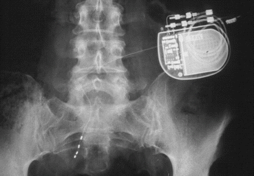 Neuromodulation Treatment of Underactive Bladder | SpringerLink