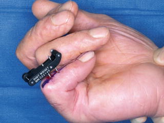 Use of Dynamic External Fixator (Digit Widget) in Dupuytren’s ...