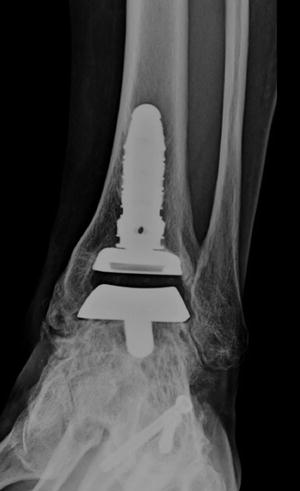 History of Total Ankle Replacement in North America | SpringerLink