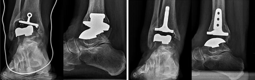The Salto Talaris XT Revision Total Ankle Replacement System | SpringerLink
