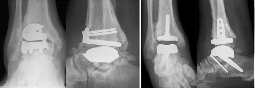 The Salto Talaris XT Revision Total Ankle Replacement System | SpringerLink