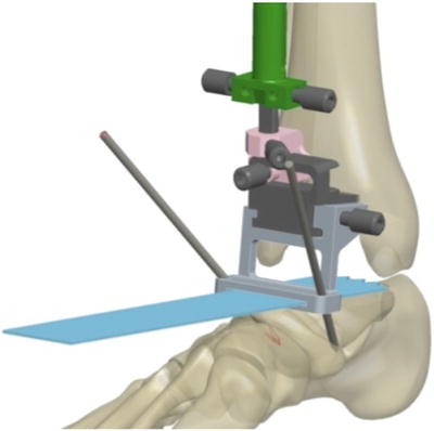 The Salto Talaris XT Revision Total Ankle Replacement System | SpringerLink