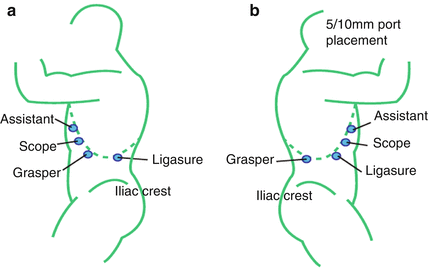 Laparoscopic Adrenalectomy: Transperitoneal Approach | SpringerLink
