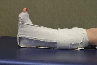 Fracture Immobilization and Splinting | SpringerLink