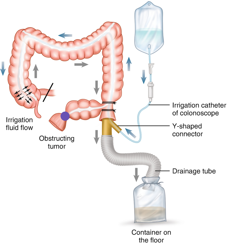 Large Bowel Obstruction | SpringerLink