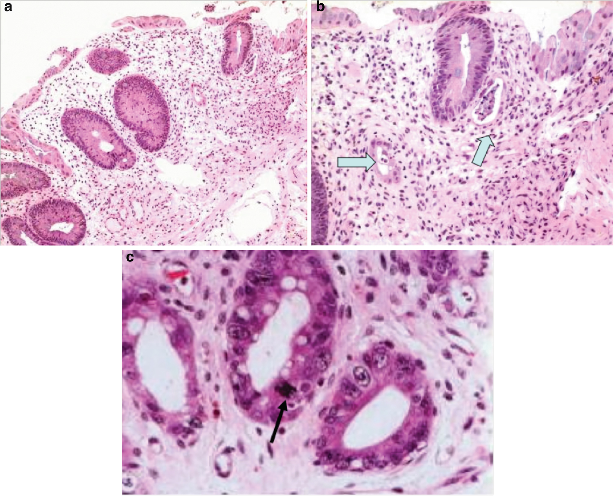 Radiation, Microscopic, Ischemic Colitis | SpringerLink
