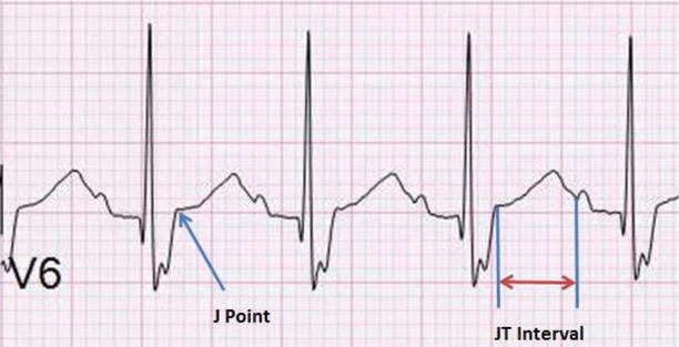 The Normal Electrocardiogram | SpringerLink