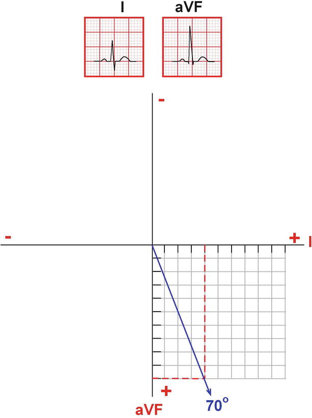 Cardiac Axis: Calculation and Interpretation | SpringerLink