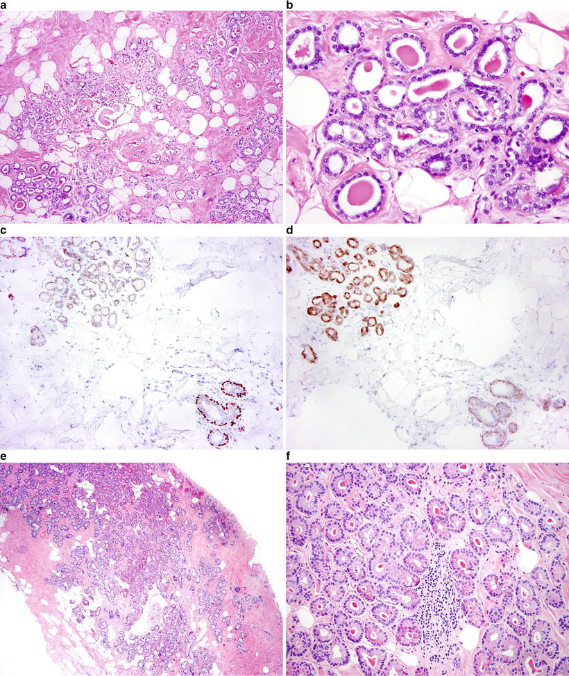 Adenosis, Sclerosing Lesions, Microglandular Adenosis, and Mucocele ...