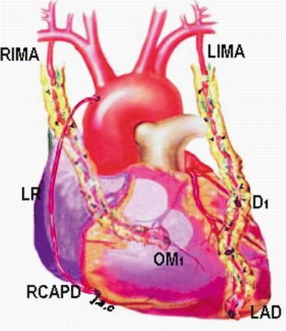 Total Arterial Myocardial Revascularization | SpringerLink