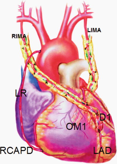 Total Arterial Myocardial Revascularization | SpringerLink