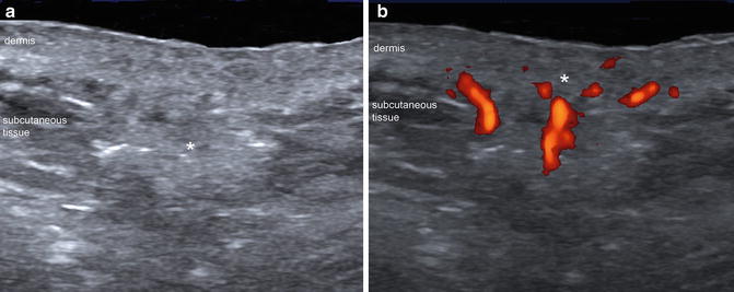 Ultrasound of the Subcutaneous Tissue | SpringerLink