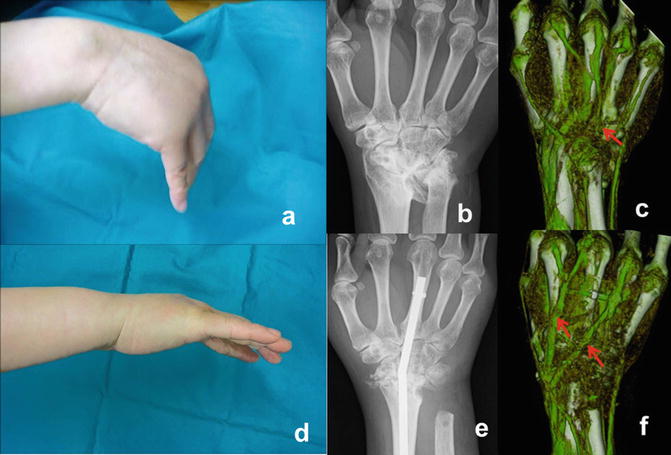 Total Wrist Fusion and Limited Wrist Fusion Procedures in Rheumatoid ...