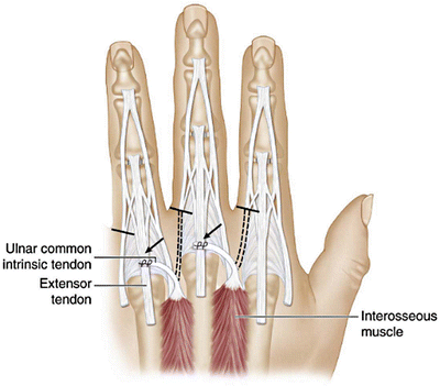 Concepts in Ulnar Drift Deformity | SpringerLink