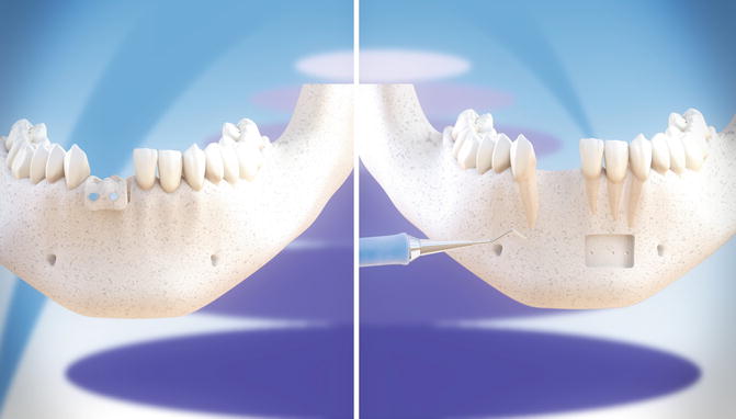 Pre-Implant Reconstructive Surgery | SpringerLink