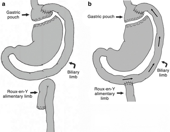 Gastrointestinal Obstruction in the Bypass Patient | SpringerLink