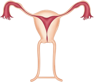 Imperforate Hymen | SpringerLink