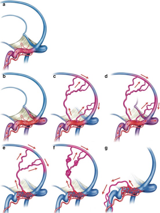 Cranial Dural AV Fistulas: Making Sense of Who to Treat and How | SpringerLink