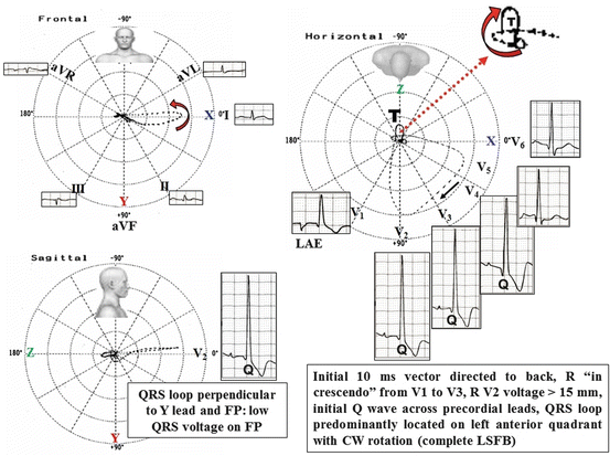 LSFB ECG/VCG Examples | SpringerLink