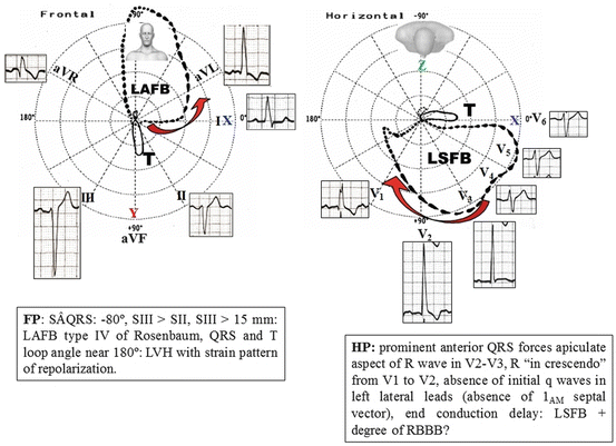 LSFB ECG/VCG Examples | SpringerLink