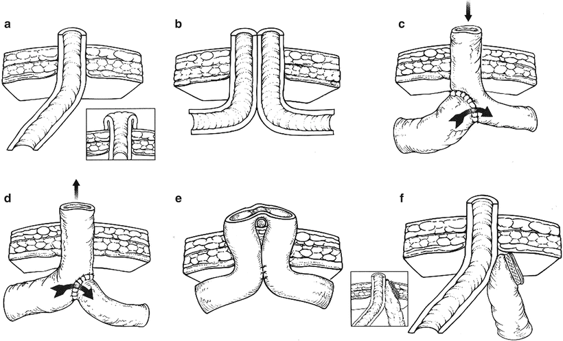 Ileostomy and Colostomy | SpringerLink