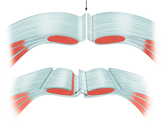 Rives-Stoppa Retromuscular Repair | SpringerLink