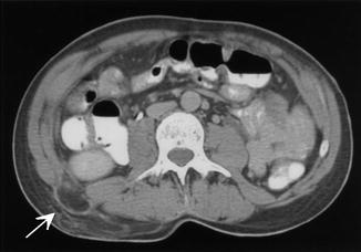 Laparoscopic Repair of Flank Hernias | SpringerLink