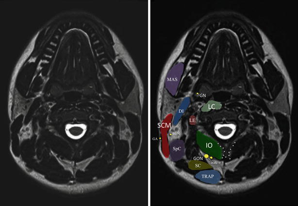 Great Auricular/Posterior Auricular Nerve Entrapment | SpringerLink