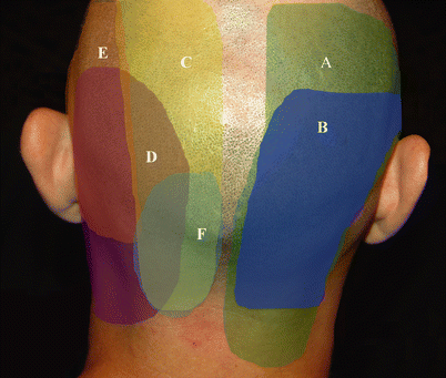 Great Auricular/Posterior Auricular Nerve Entrapment | SpringerLink
