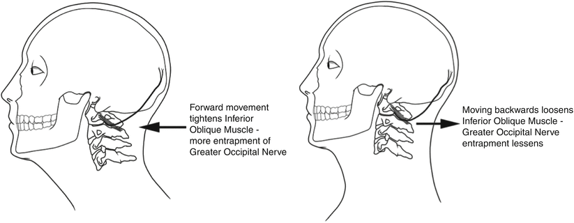 Lesser Occipital Nerve Entrapment | SpringerLink