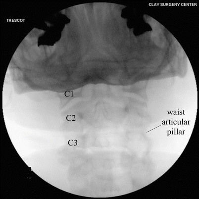 Third Occipital Nerve Entrapment | SpringerLink