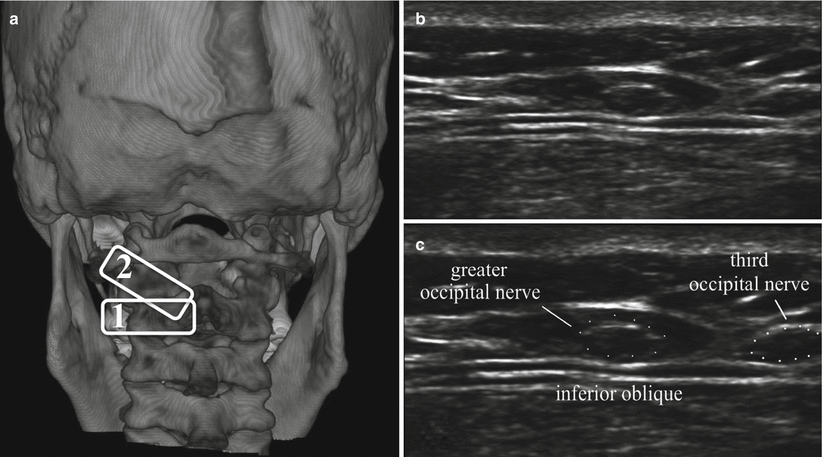 Third Occipital Nerve Entrapment | SpringerLink