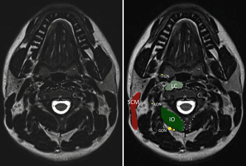 Third Occipital Nerve Entrapment | SpringerLink