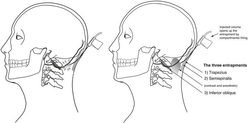 Suboccipital Neuralgia and Decompression | SpringerLink