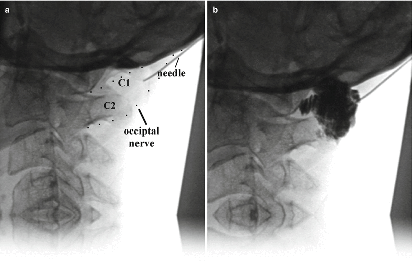 Suboccipital Neuralgia and Decompression | SpringerLink