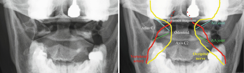 Suboccipital Neuralgia and Decompression | SpringerLink