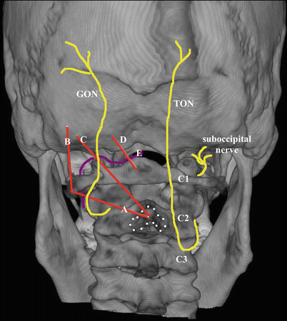 Suboccipital Neuralgia and Decompression | SpringerLink
