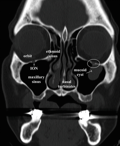 Infraorbital Nerve Entrapment | SpringerLink