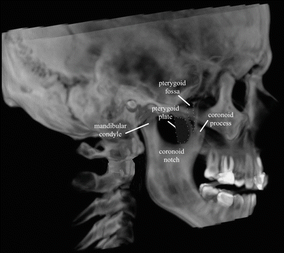 Mandibular Nerve Entrapment | SpringerLink