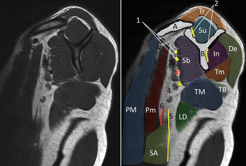 Spinal Accessory Nerve Entrapment | SpringerLink