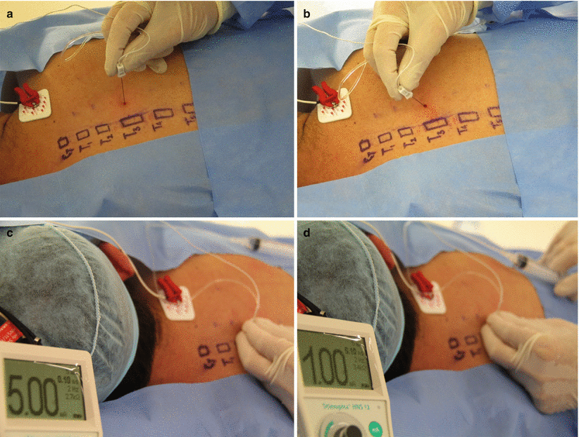 Intercostal Nerve Entrapment: Chest Wall | SpringerLink