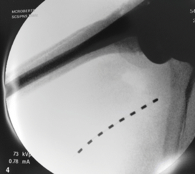 Axillary Nerve Entrapment | SpringerLink