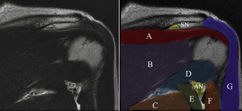 Axillary Nerve Entrapment | SpringerLink