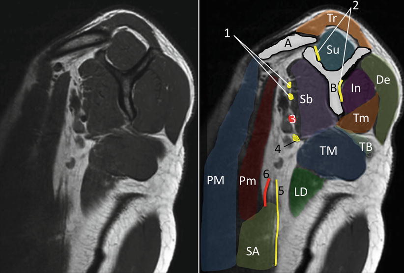 Axillary Nerve Entrapment | SpringerLink