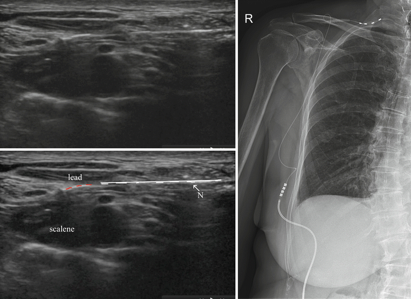 Thoracic Outlet Syndrome (Neurogenic) | SpringerLink