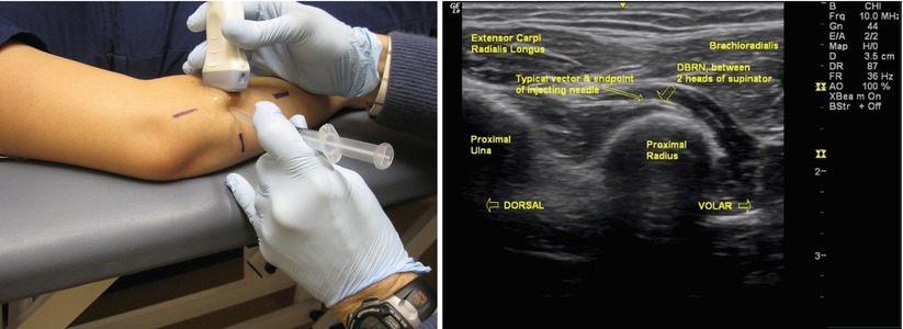 Deep Branch of the Radial Nerve Entrapment | SpringerLink