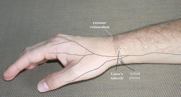 Superficial Radial Nerve Entrapment | SpringerLink