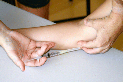 Ulnar Nerve Entrapment | SpringerLink