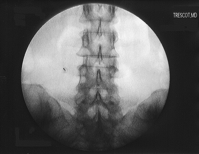Lumbar Plexus Entrapment: Abdominal | SpringerLink