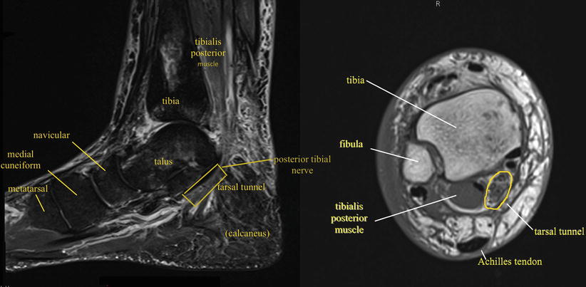 Lateral Plantar Nerve Entrapment | SpringerLink